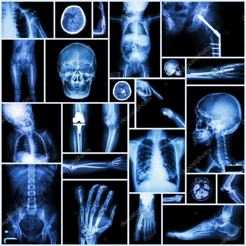 Collection X-ray "Multiple part of human" ,"Orthopedic surgery" and ...