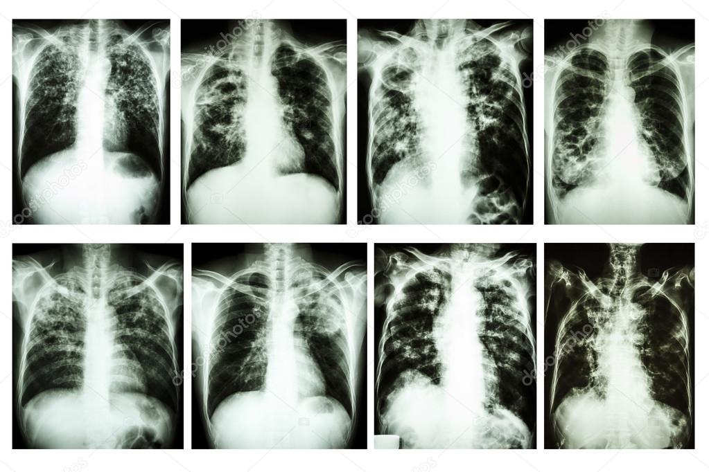 Collection of chest x-ray Collection of chest x-ray