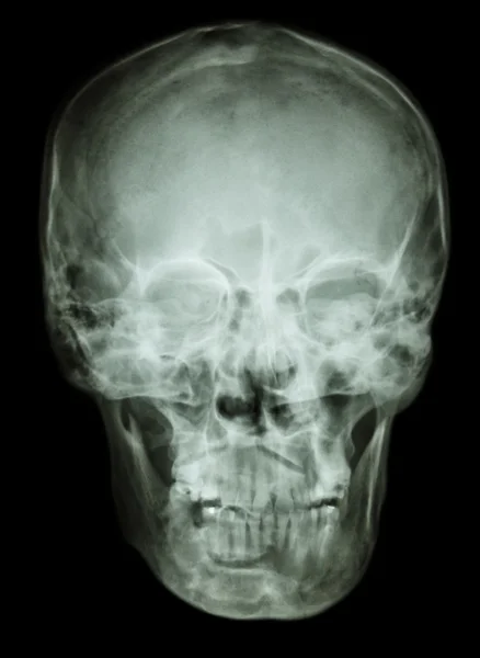 Normal human skull - Stock Image - Everypixel