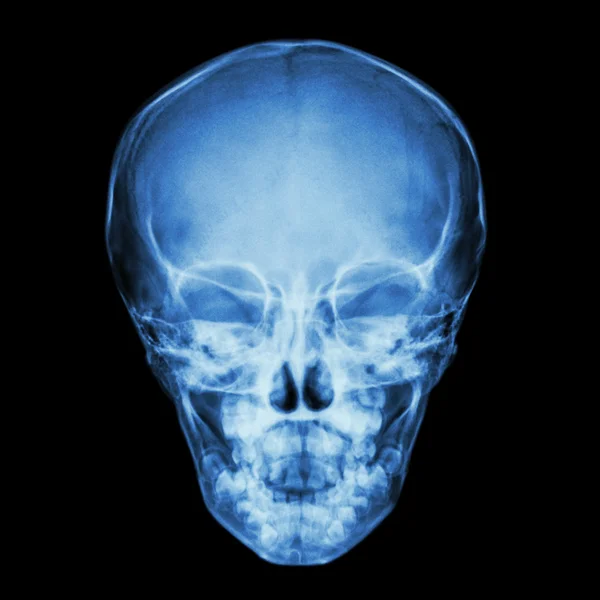 X-ray normal skull and cervical spine . Lateral view . Invert color ...
