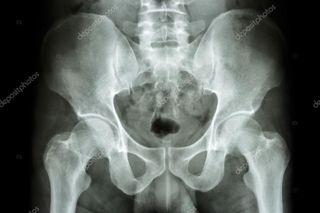 Pelvis humana y articulaciones de cadera — Foto de stock © stockdevil ...