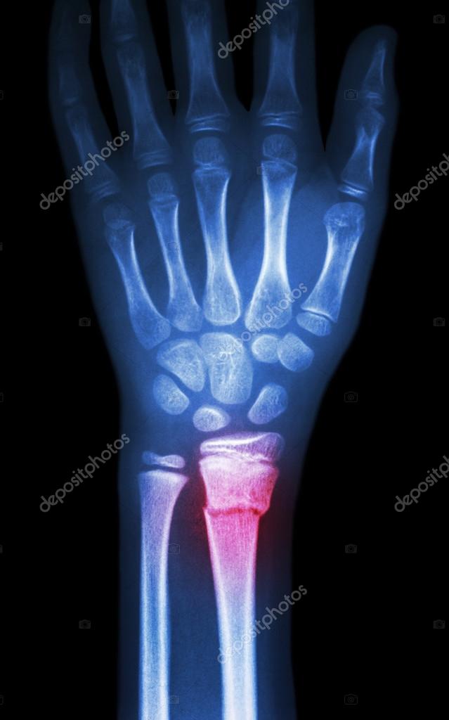 Fractura del radio distal (hueso del antebrazo ) — Foto de stock ...