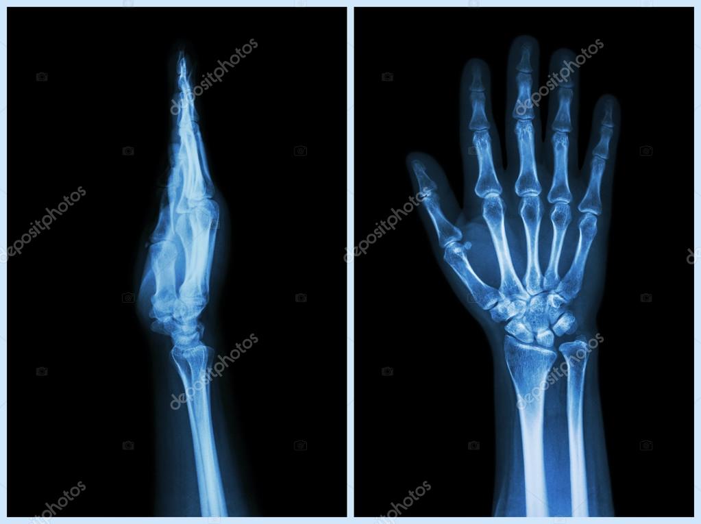X Ray Of Hand Paget's Hand | Reumatología Clínica