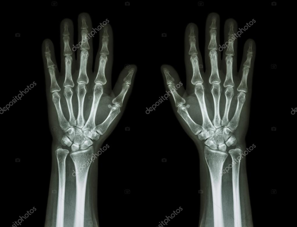 Manos de rayos X (vista frontal): Manos humanas normales — Foto de ...