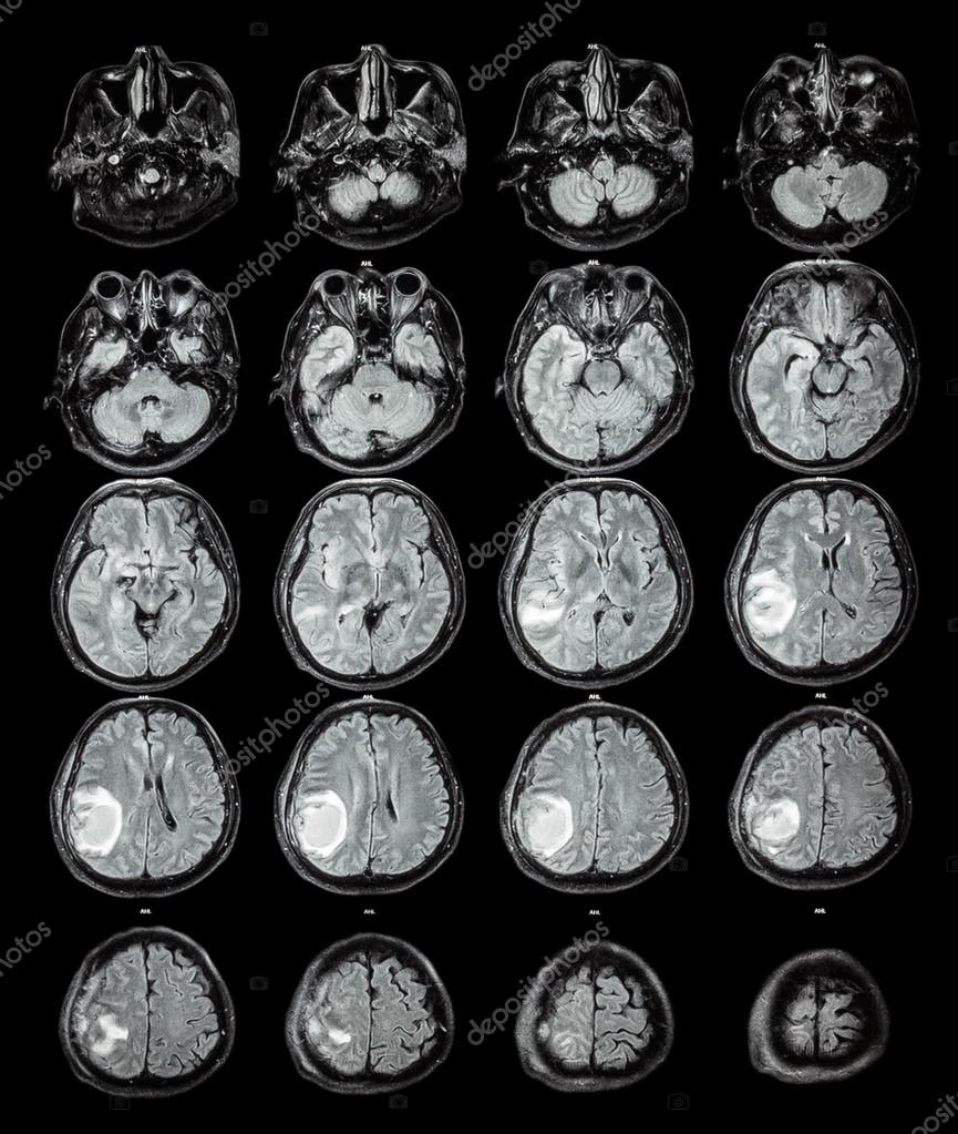 MRI brain : Brain tumor at right parietal lobe — Stock Photo ...
