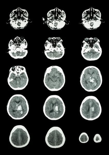 Stroke hemoragik dan Stroke Iskemik. CT scan otak: pendarahan ...