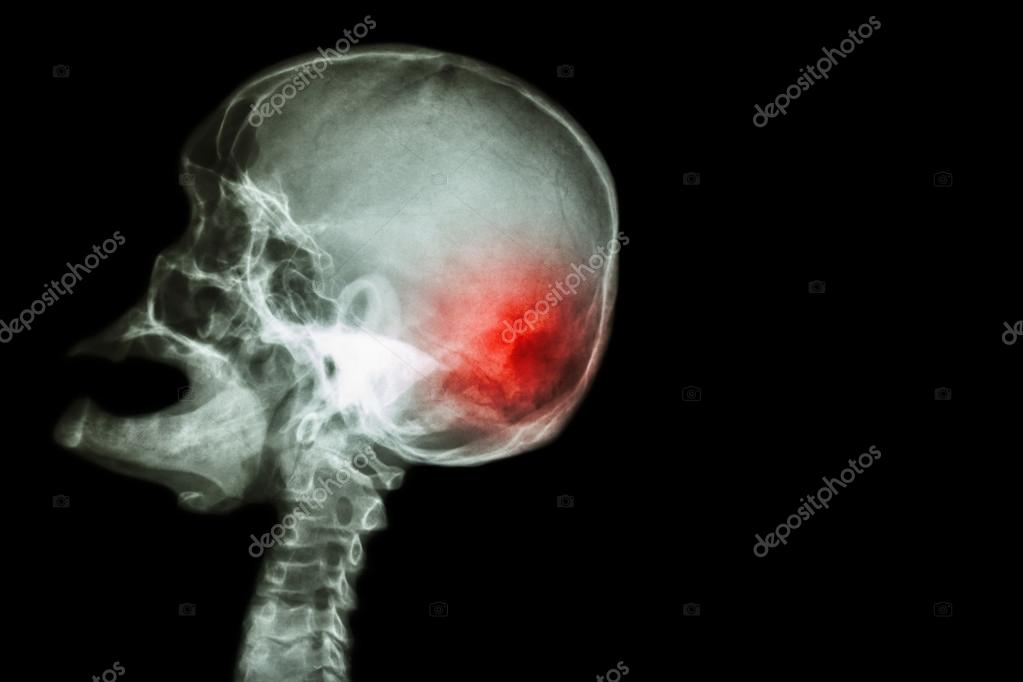 Human Skull Right Side View