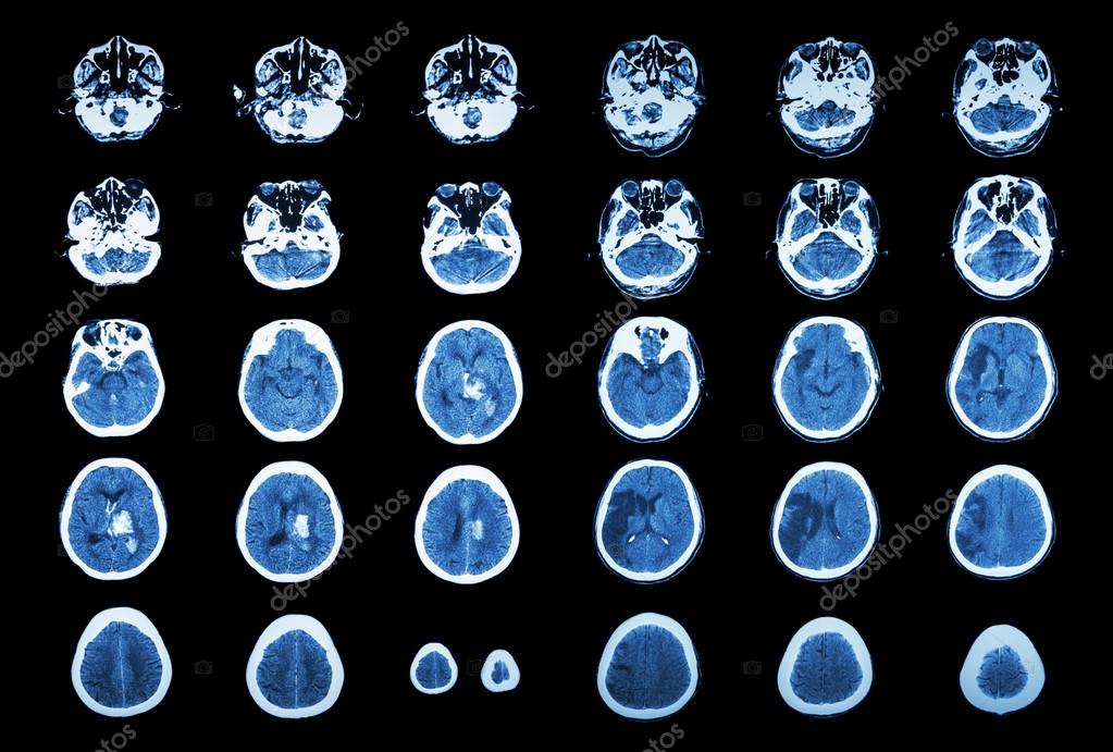 Stroke hemoragik dan Stroke Iskemik. CT scan otak: pendarahan ...
