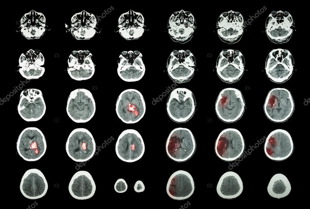 AVC hémorragique et AVC ischémique. CT scan du cerveau : hémorragie ...
