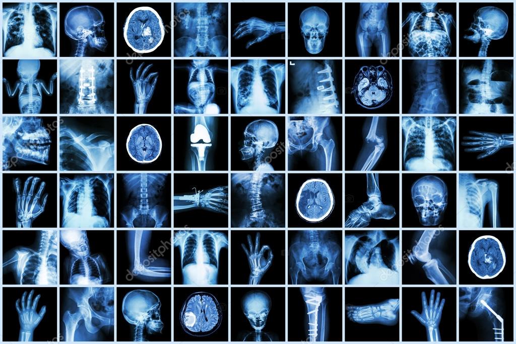 X-ray multiple part of adult and child and Disease ( Pulmonary ...