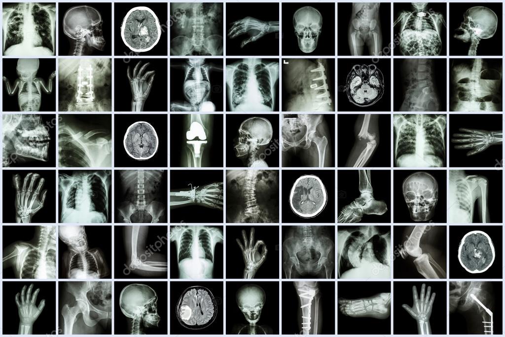 Radiografía parte múltiple de adulto y niño y enfermedad (tuberculosis ...
