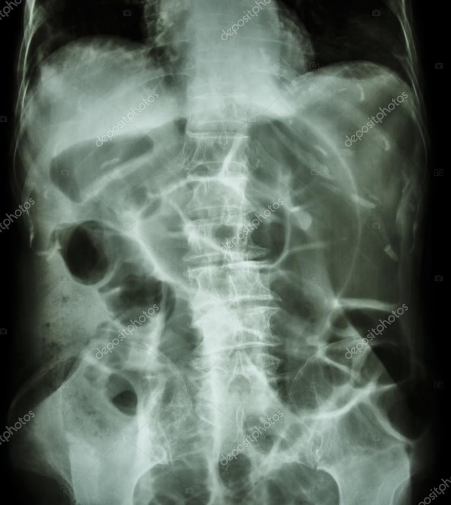 Bowel Obstruction ( X-ray abdomen supine position : large bowel — Stock ...