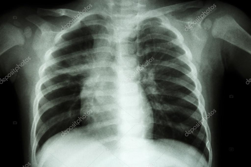 Tuberculosis pulmonar (radiografía de tórax del niño: muestra ...