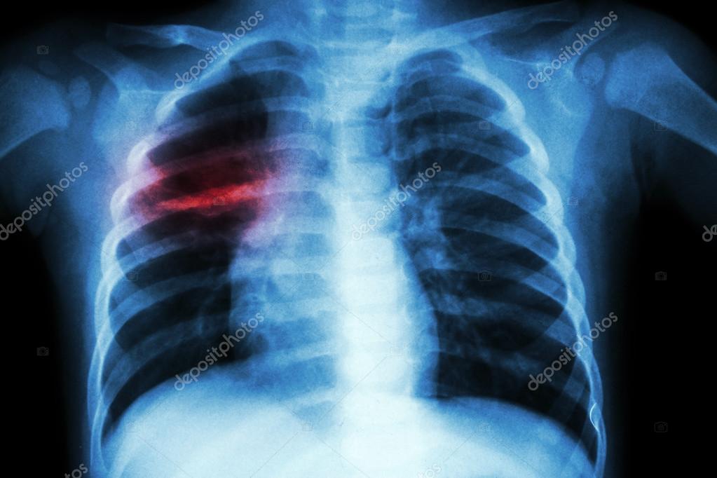 Tuberculose pulmonar (radiografia de tórax da criança: mostrar ...