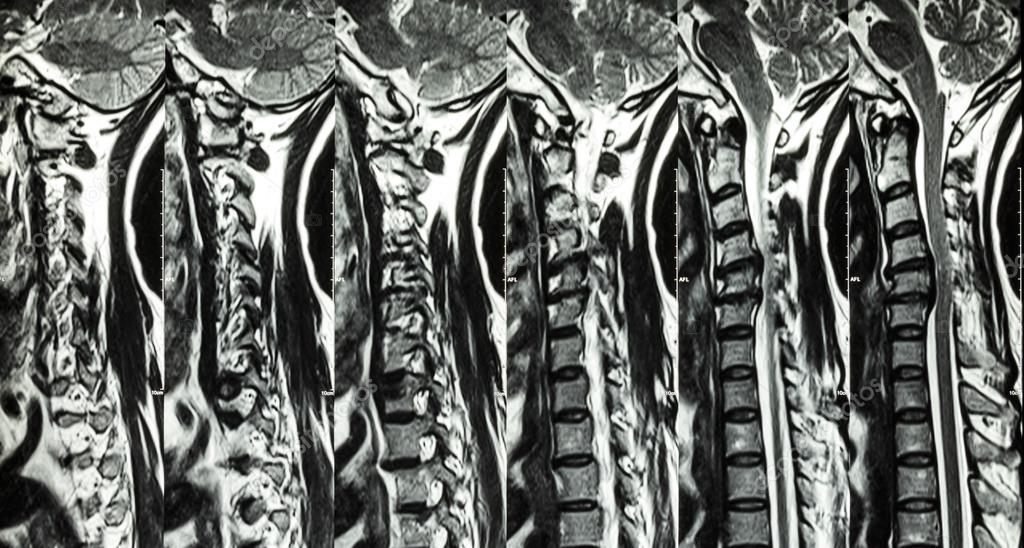Cervical spondylosis with disc herniation ( MRI of cervical spine ...