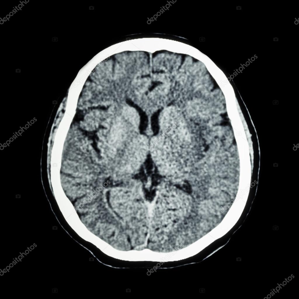 CT scan of brain : show normal human 's brain ( CAT scan ) — Stock ...