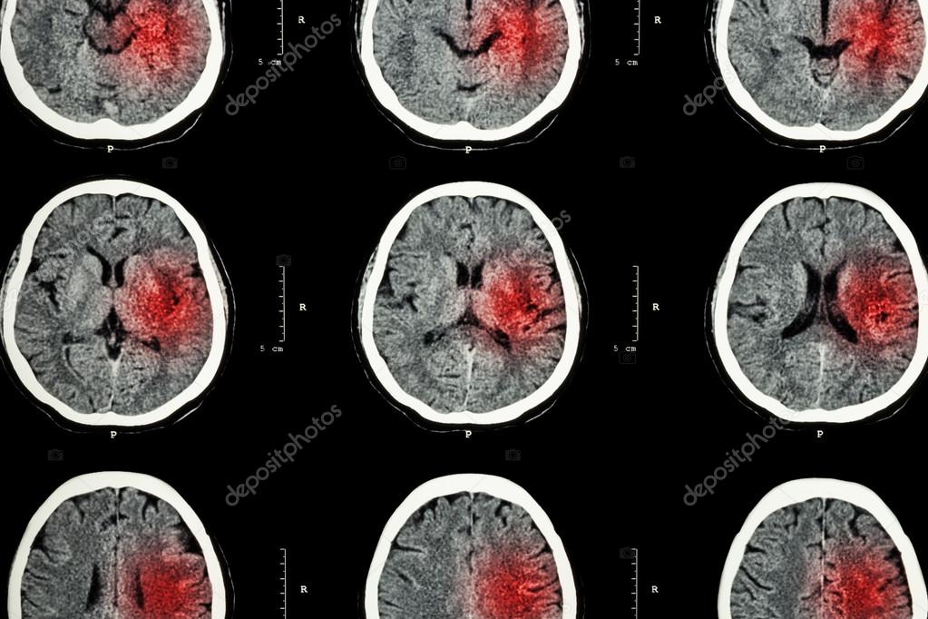 CT scan of brain with red area ( Imaging for hemorrhagic stroke or ...
