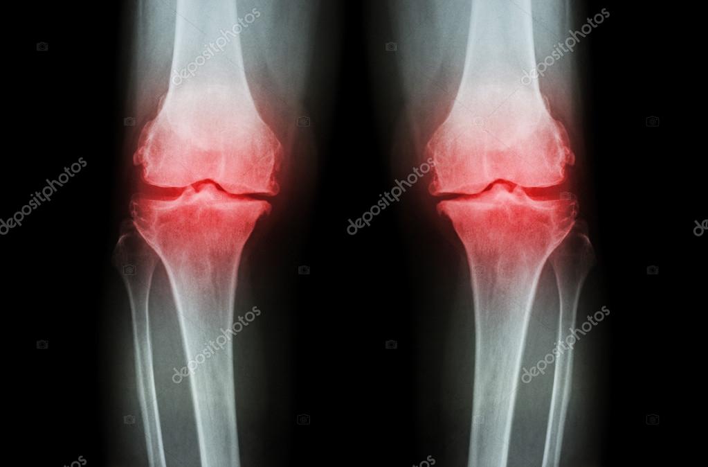 Osteoarthritis Knee ( OA Knee ). Film x-ray both knee ( front view ...