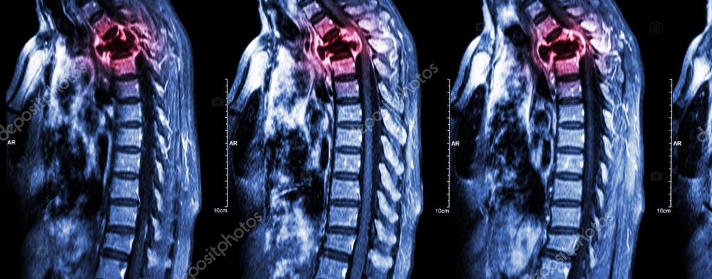 Métastases de la colonne vertébrale (propagation du cancer à la colonne ...