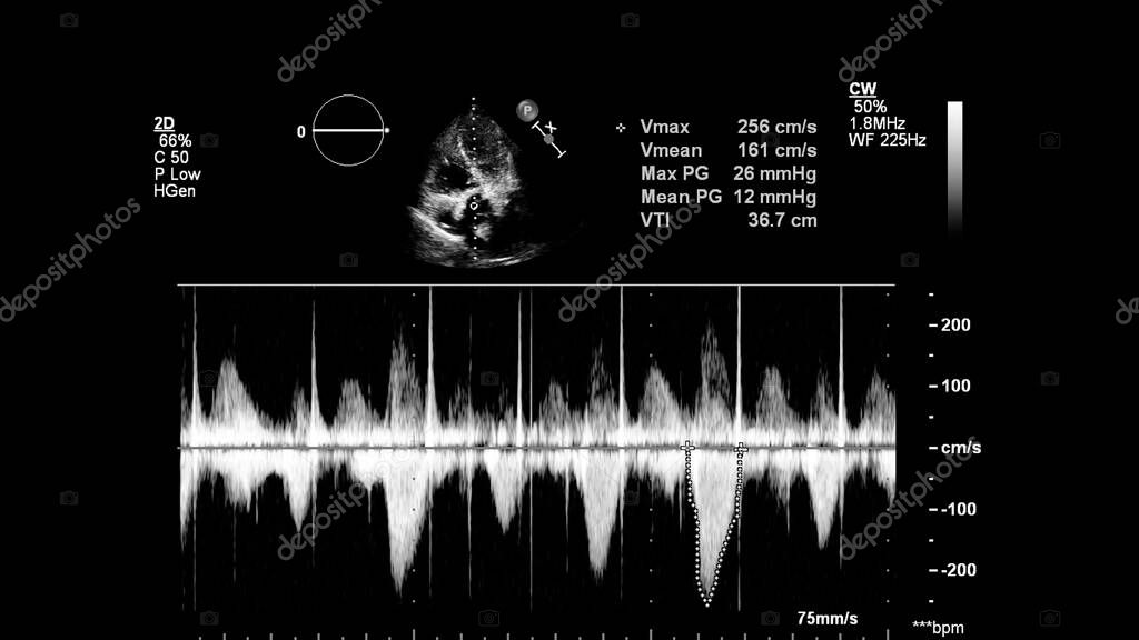 Imagen del corazón en modo de escala gris durante la ecografía ...