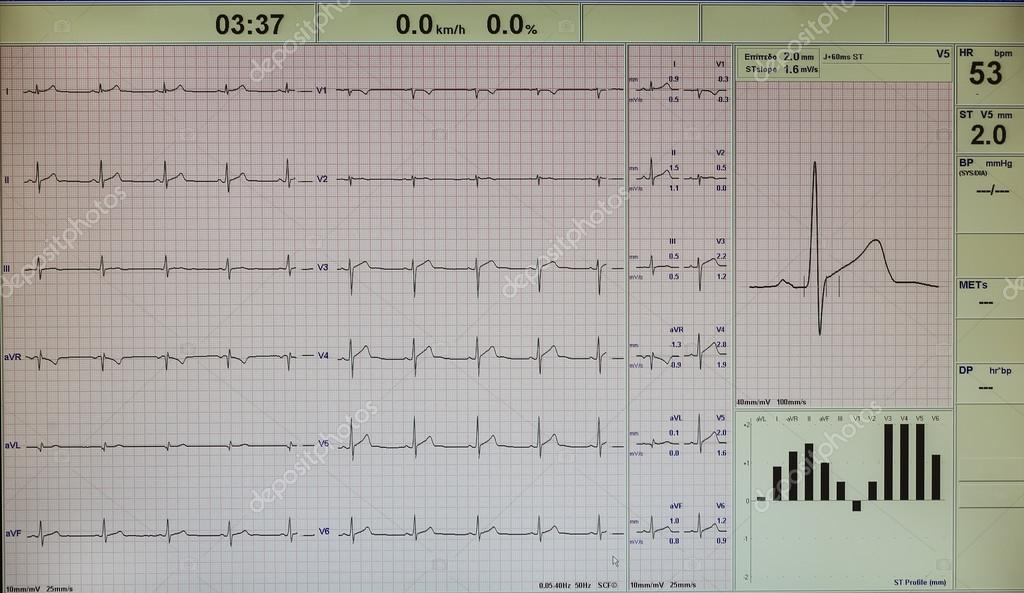 Imagen del cardiograma en la pantalla del ordenador del hospital 2023
