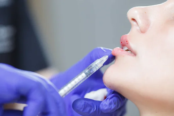 aumento de labios inyectable con rellenos. Enfoque selectivo 2024