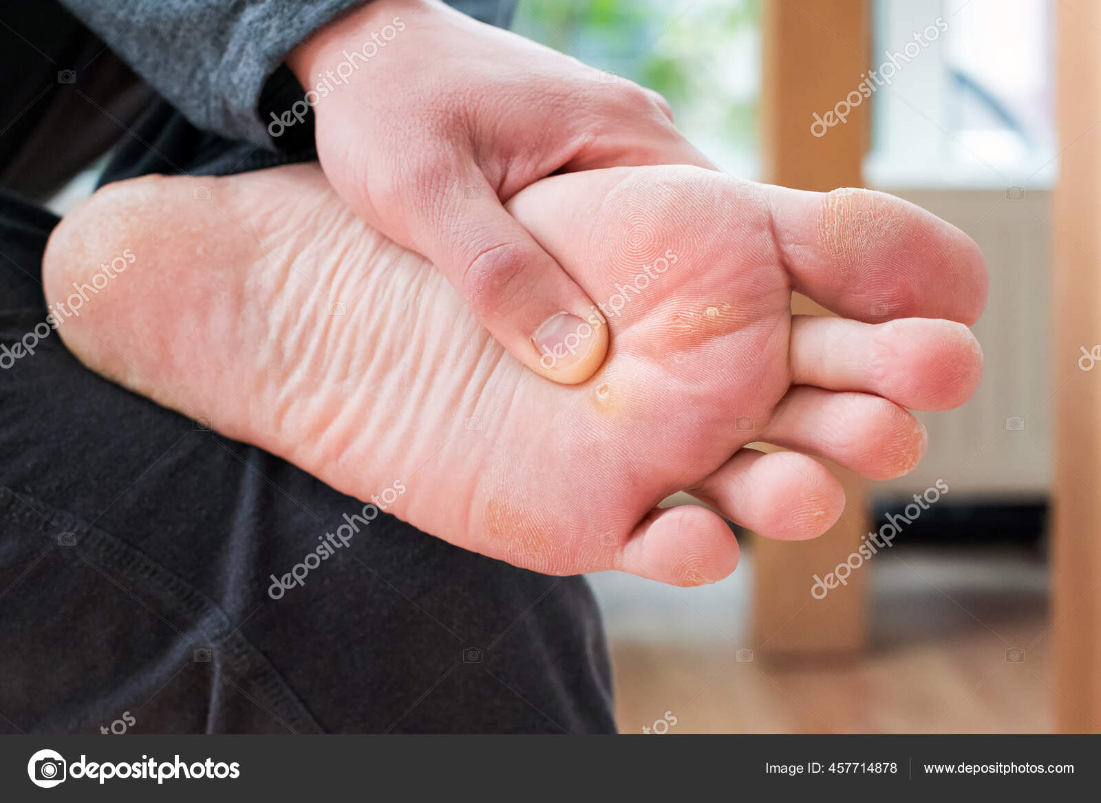 Pie Con Callos Callos Piel Seca Verrugas Plantares Virus Del — Foto de ...