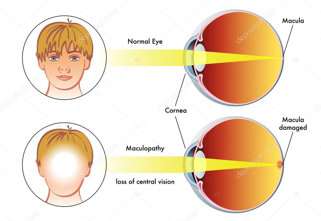 Illustration of the symptoms of maculopathy Stock Vector Image by ...