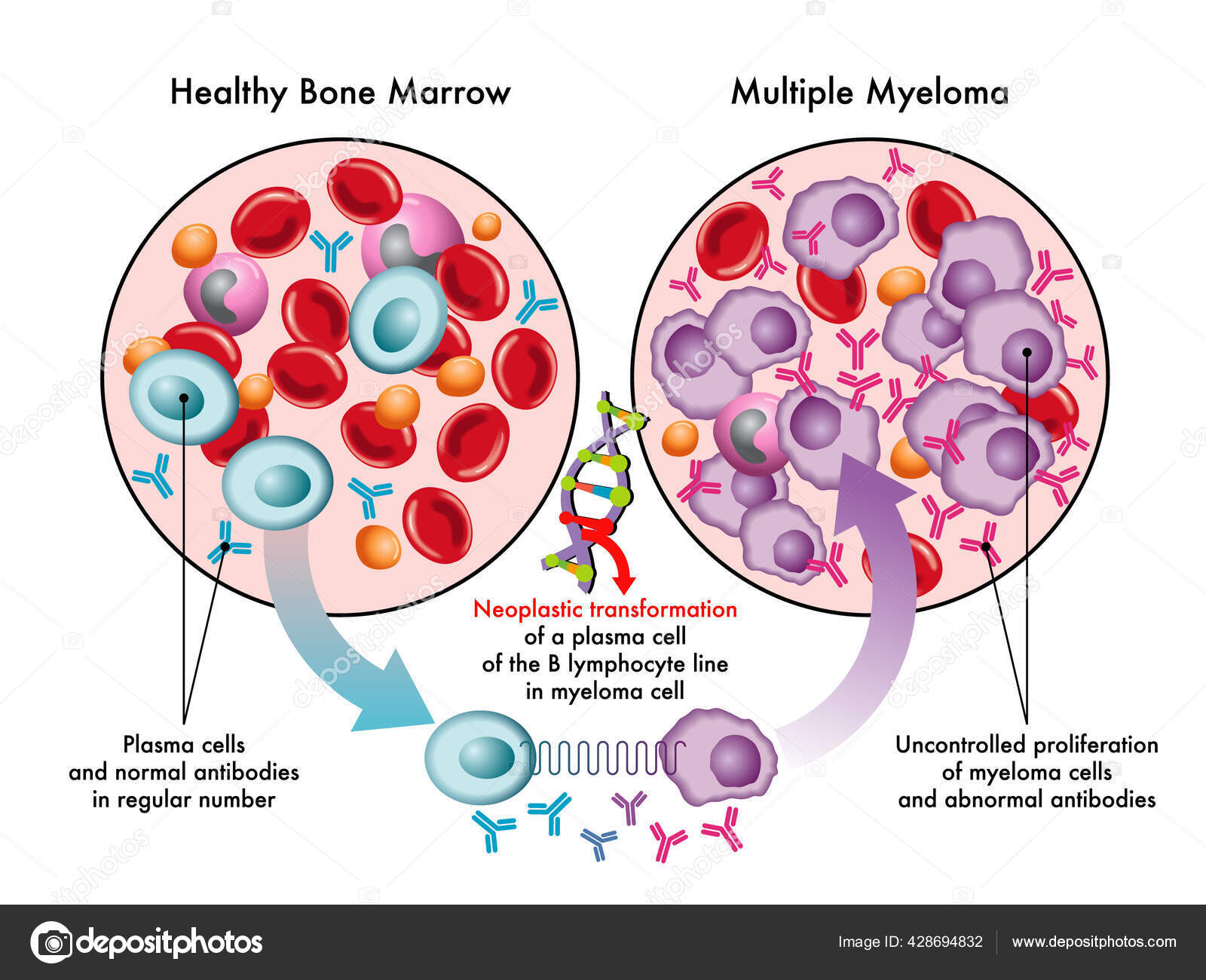 Ilustración Médica Que Muestra Transformación Las Células Plasmáticas ...