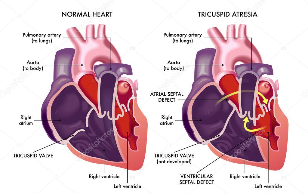 Ilustración médica que compara el corazón normal con el corazón ...