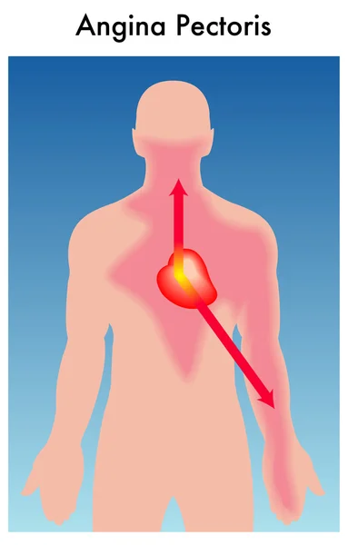 Angina pectoris, Royalty-free Angina pectoris Vector Images & Drawings ...
