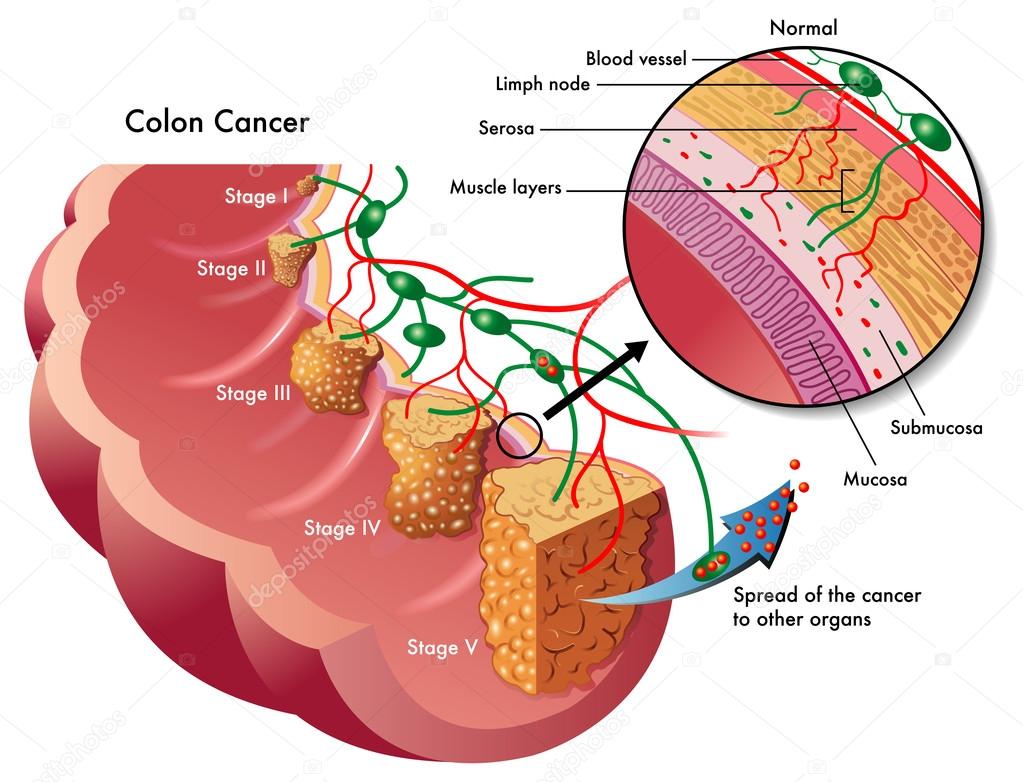 Colon cancer — Stock Vector © rob3000 #60338355 Colon cancer — Stock Vector © rob3000 #60338355
