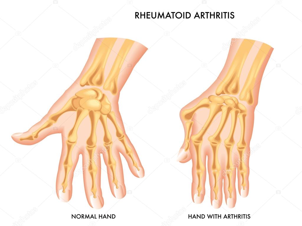 Rheumatoid Arthritis Stock Vector Image by ©rob3000 #65937357