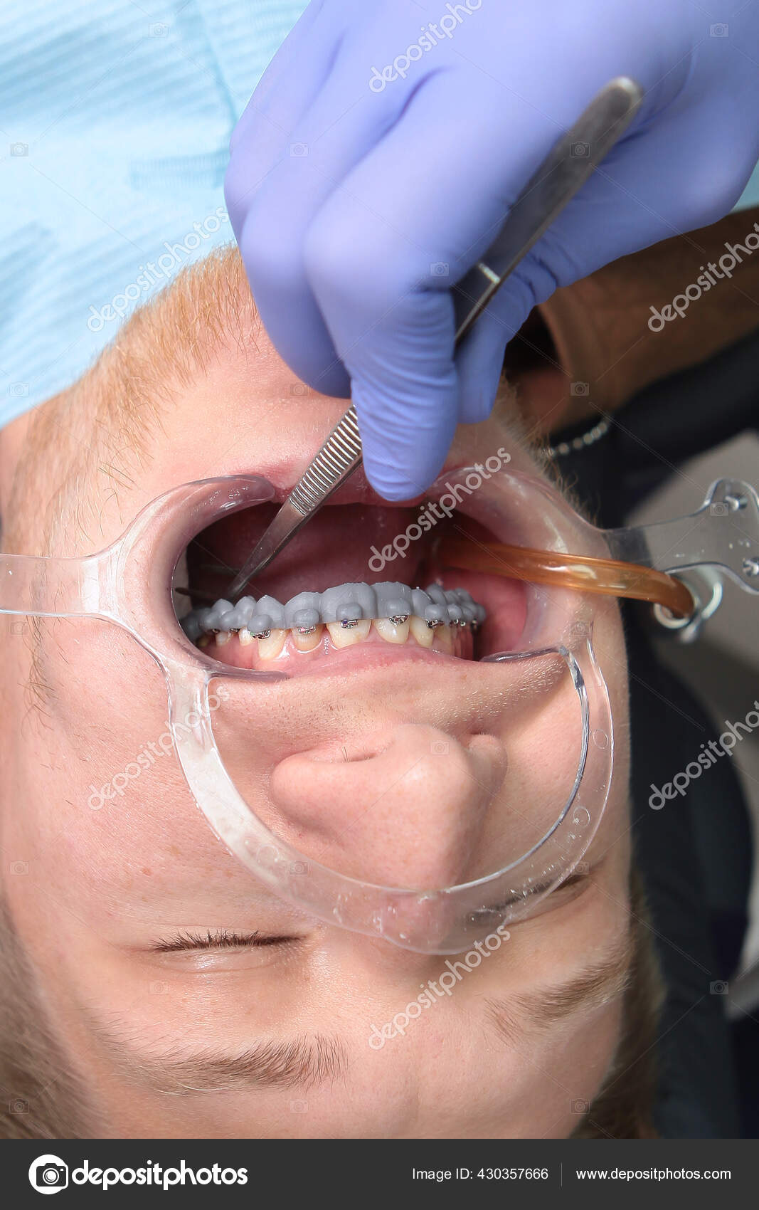 Anchors The Upper Row Of Teeth at Marsha Mitchell blog