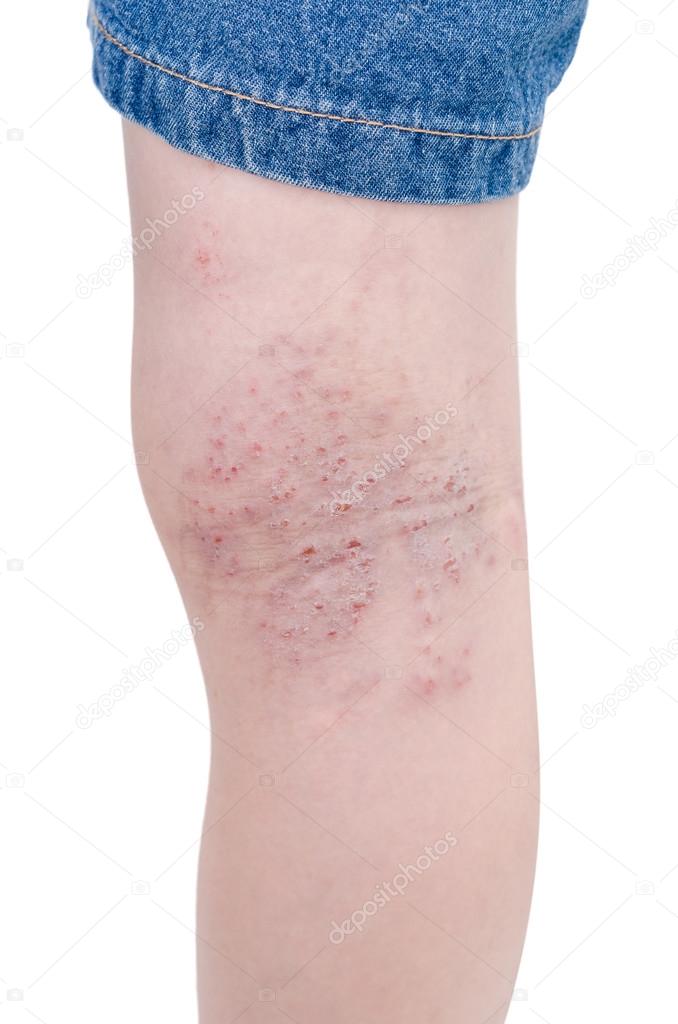 Leg with sore from scratching — Stock Photo © parinyabinsuk #109686954
