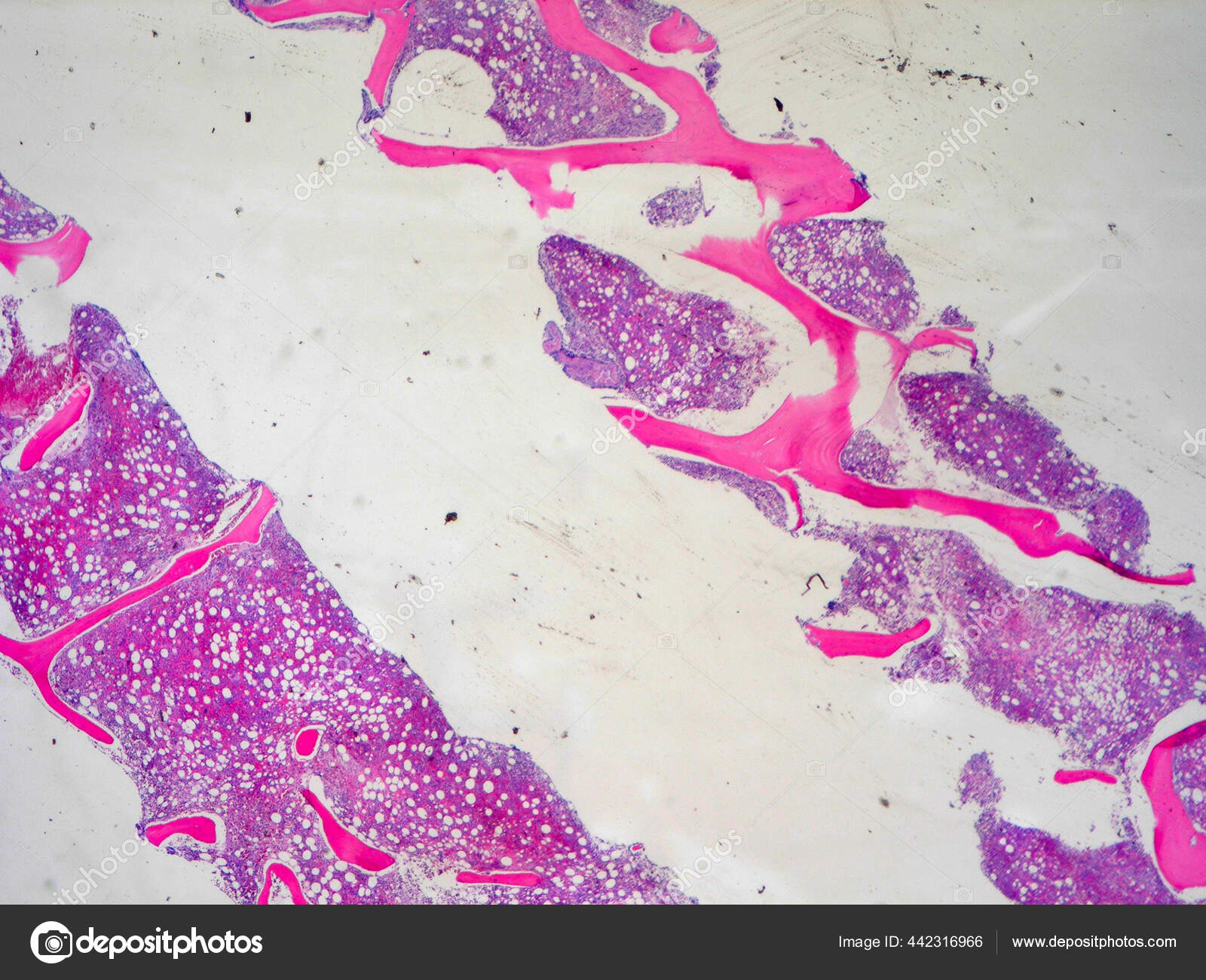 Bone Marrow Core Biopsy Pathology Sections H And E Stain — Stock