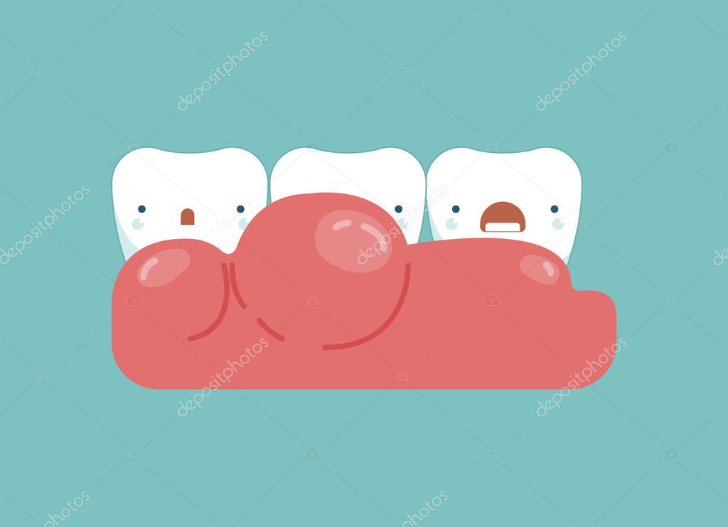 Gingivitis around the teeth ,dental concept Stock Vector by ©kninwong ...