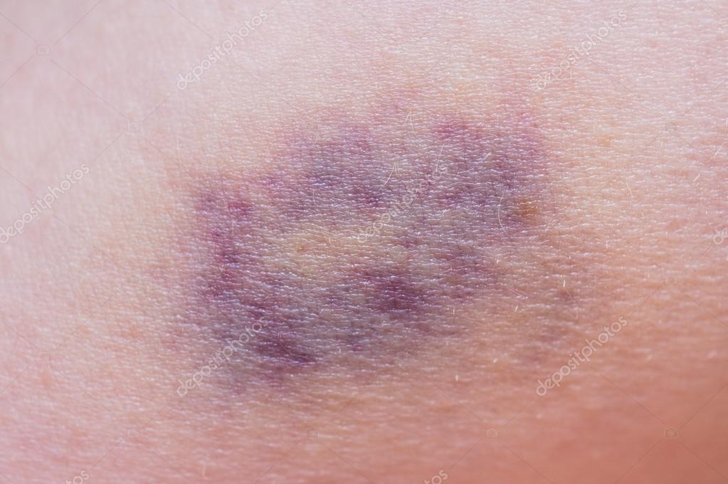 Macro tiro de hematoma roxo na pele . fotos, imagens de © vchalup2 ...