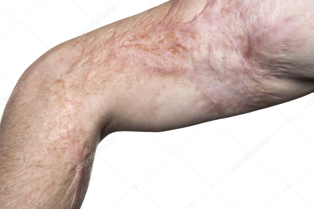 Burn — Stock Photo © marcinmaslowski #61847999