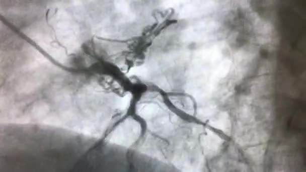 Coronary Angiography Coronary Artery Perforation Cap Rare Feared ...