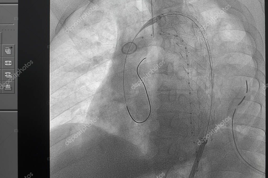 Angiograma de la arteria ilíaca común derecha después del injerto de ...