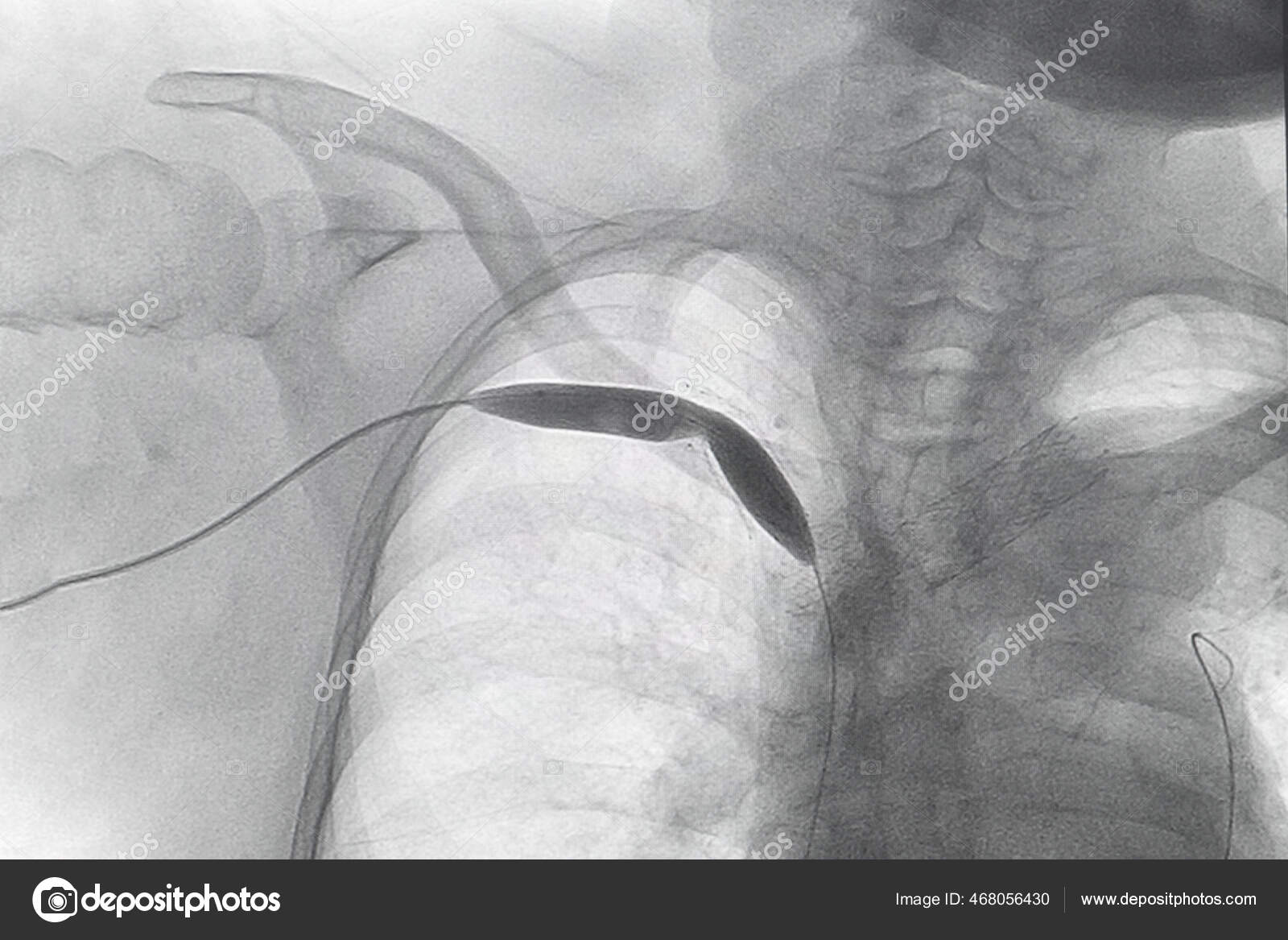 Angioplasty Balloon Angioplasty Percutaneous Transluminal Angioplasty ...