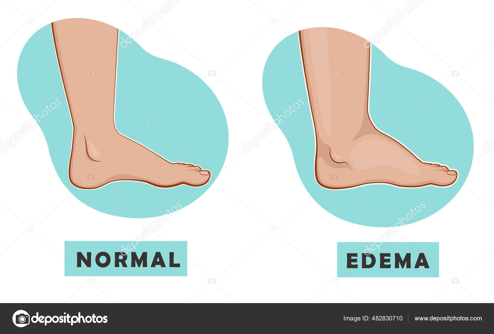 Moderate Edema