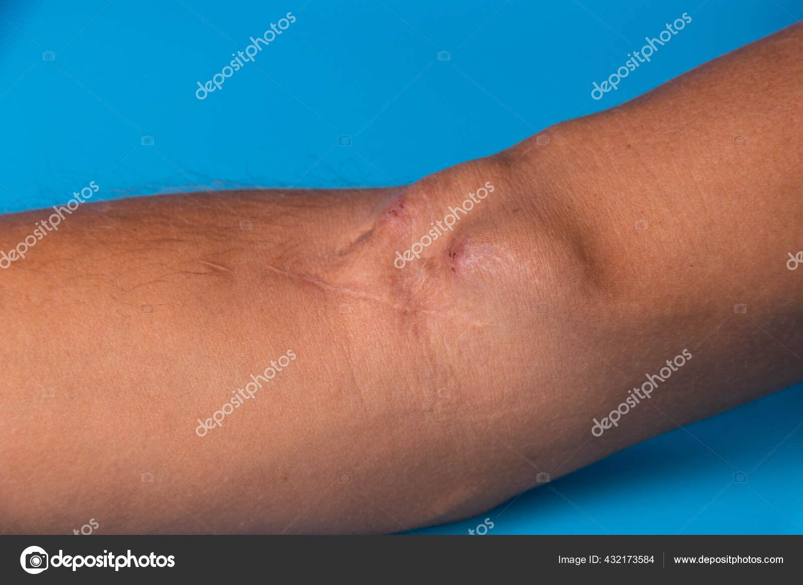 Fistel Armen Som Følge Operation Hæmodialyse Med Nyresvigt — Stockfoto ...