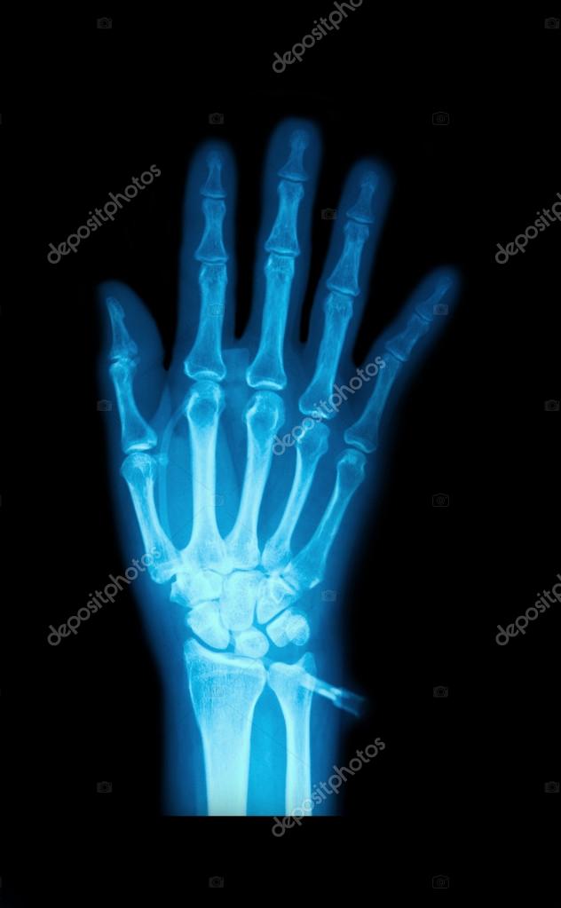 X-Ray image of human hands — Stock Photo © gamjai #52272293