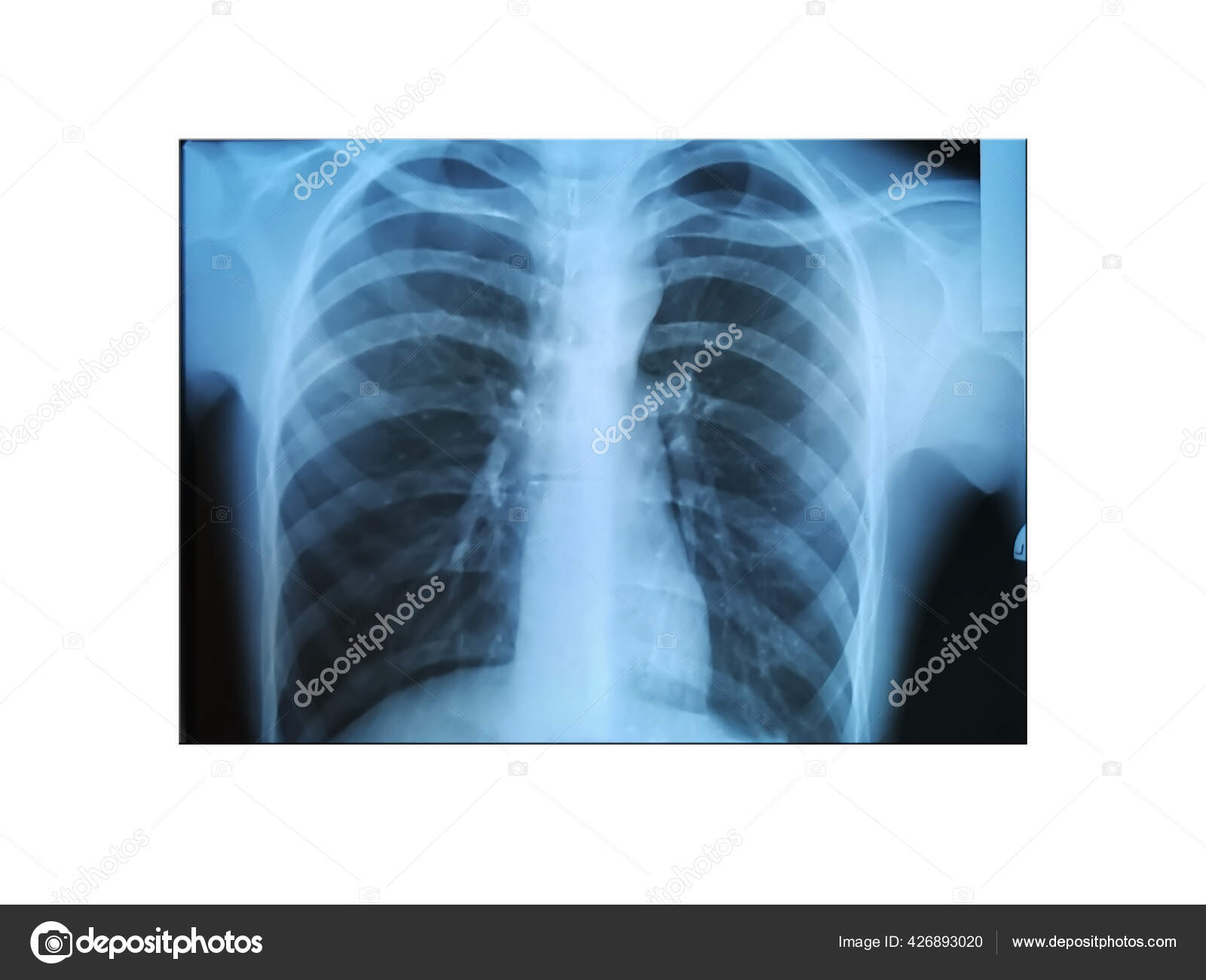 Normal Plain Chest Ray Healthy Heart Lungs — Stock Photo © Nik_Ta ...