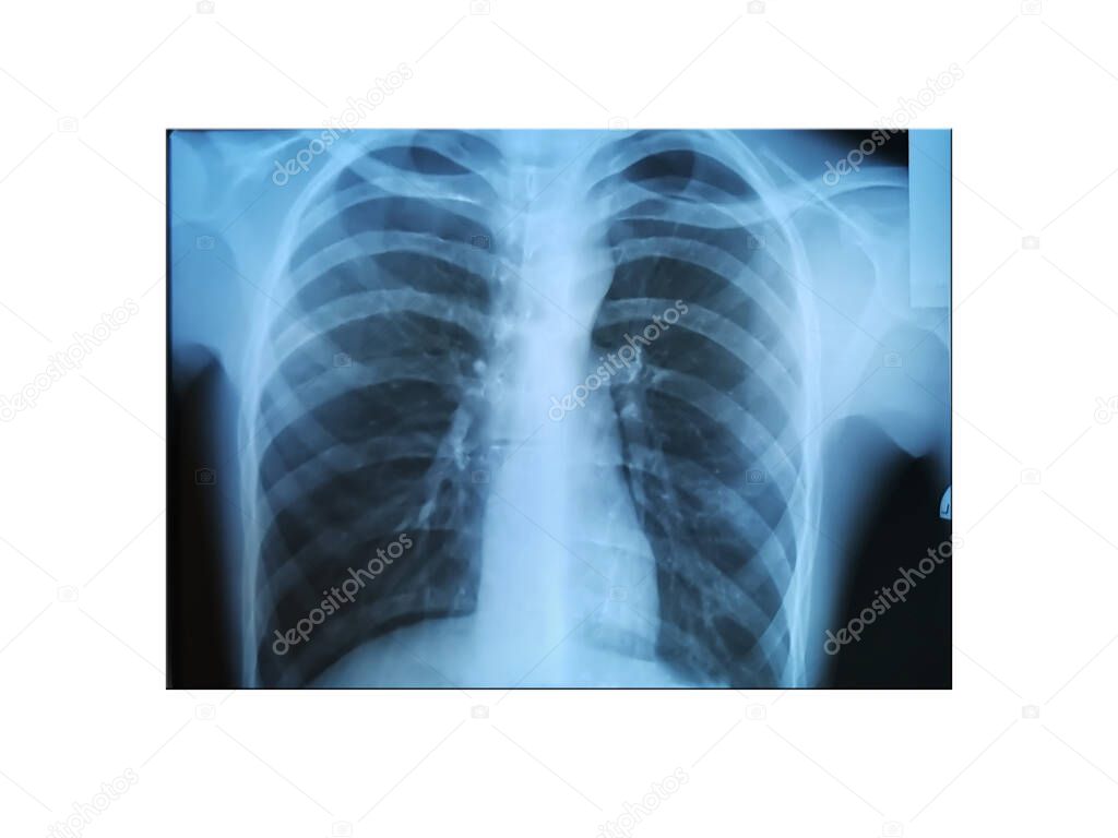 Radiografía normal de tórax simple: corazón y pulmones sanos 2022