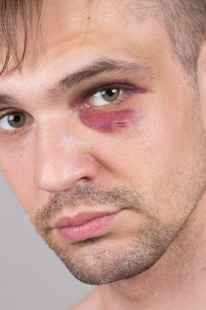 Man with an injured eye. Closeup. — Stock Photo © kopitin #76685963