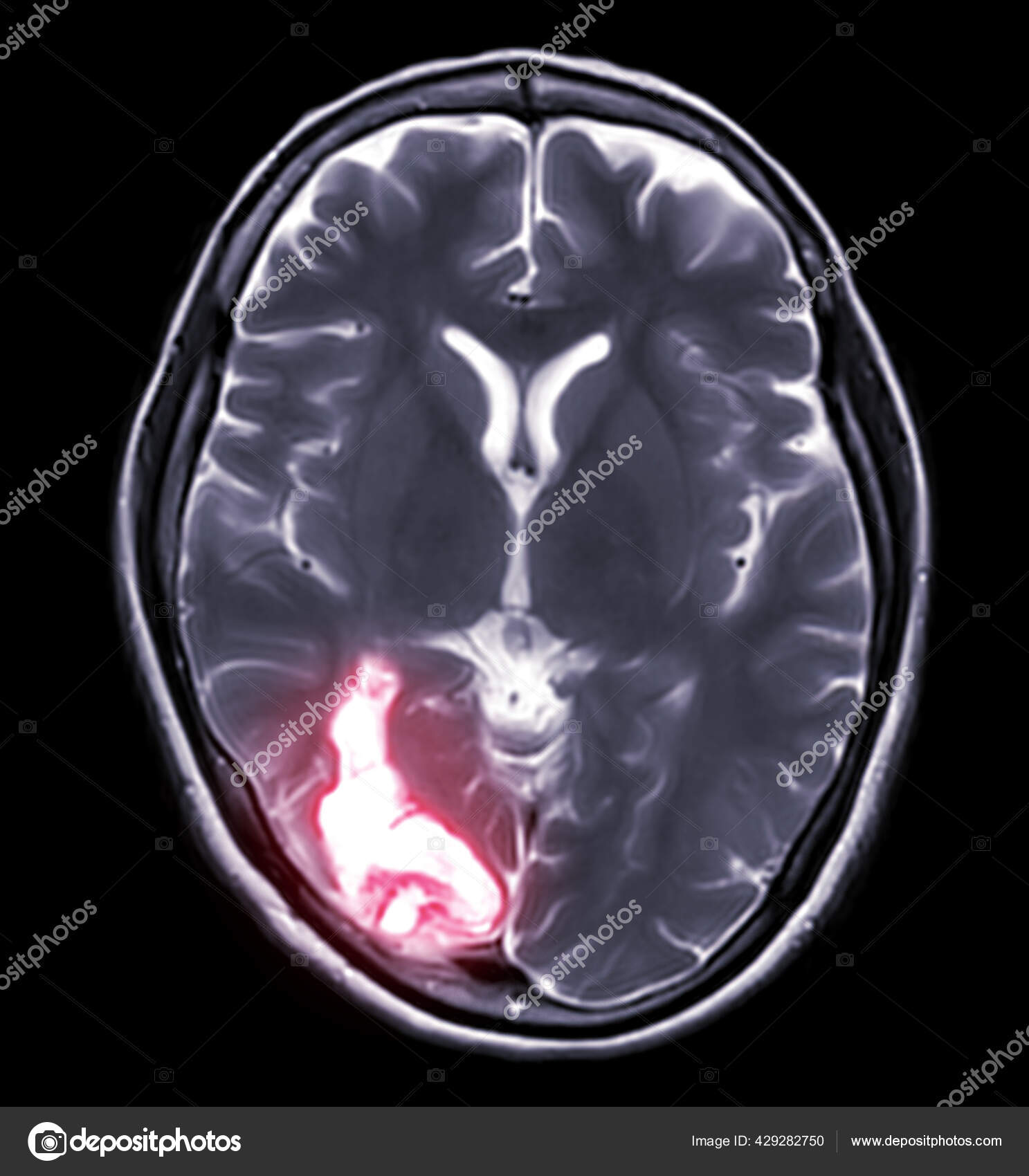 Mri Brain Axial T2W View Showing Enchepalomalacia Disease Stock Photo by ©samunella 429282750