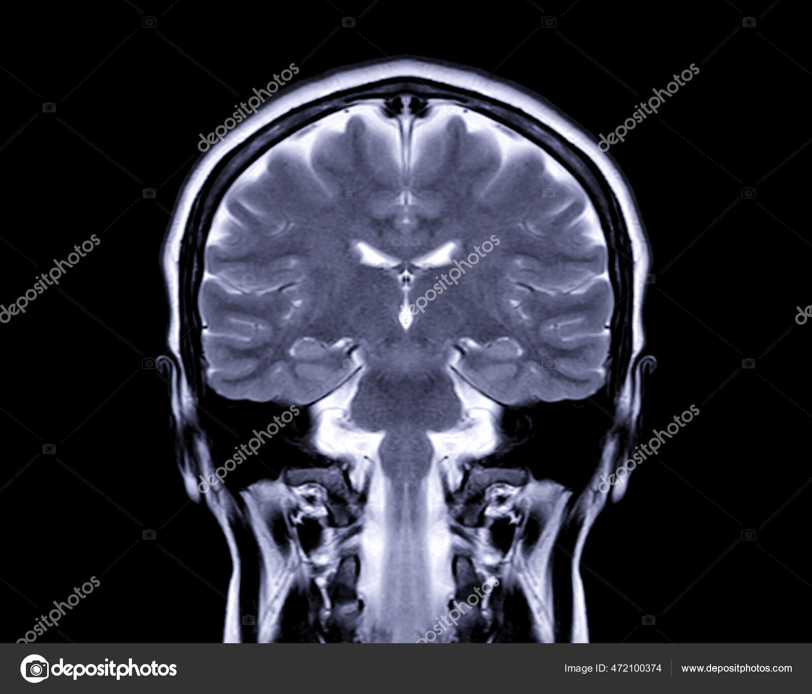 Coronal View Of Brain Mri